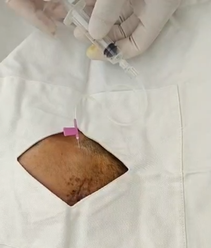 突破！青岛西海岸第二医院神经外科成功实施首例Ommaya囊植入术，精准狙击脑膜恶性肿瘤 - 青岛频道