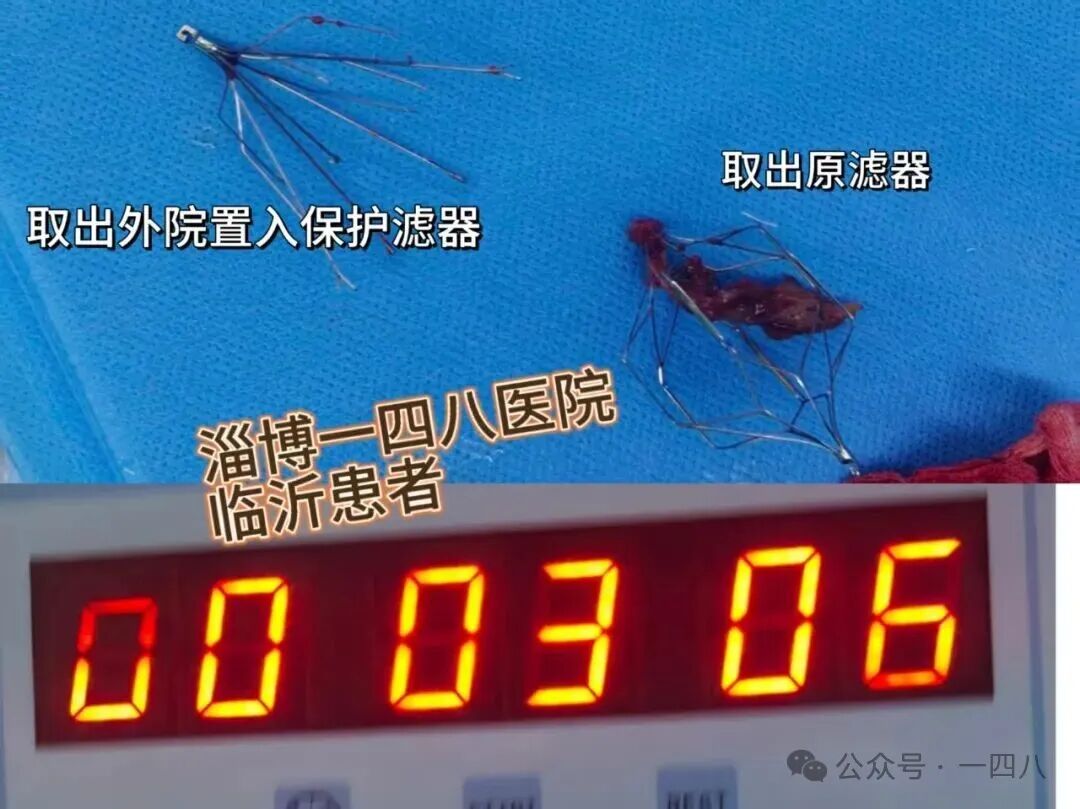 淄博一四八医院成功为丹东、临沂患者取出疑难滤器 - 鲁网·淄博